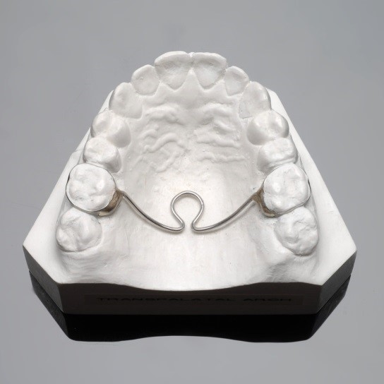 TANATAREC Orthodontics • Trans-Palatal Arch (TPA)